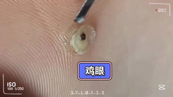 鸡眼挖出来的根图片_鸡眼根长什么样-第2张图片-山城妙识