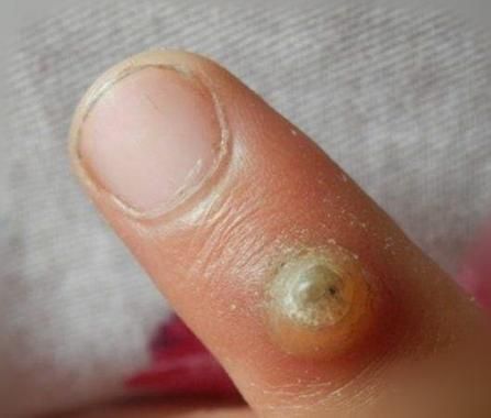 鸡眼挖出来的根图片_鸡眼根长什么样-第3张图片-山城妙识