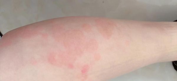 吃海鲜过敏会出现什么症状_海鲜过敏症状多久出现-第2张图片-山城妙识 吃海鲜过敏会出现什么症状_海鲜过敏症状多久出现-第2张图片-山城妙识