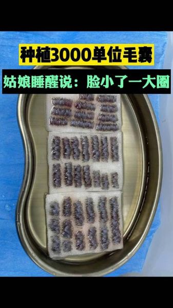 植发3000个毛囊价格_植发3000个毛囊多少钱-第3张图片-山城妙识 植发3000个毛囊价格_植发3000个毛囊多少钱-第3张图片-山城妙识