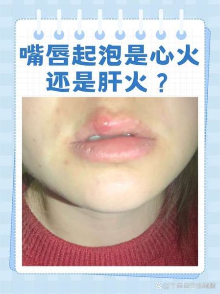 嘴巴上火怎么快速降火_嘴角起泡吃什么好-第1张图片-山城妙识 嘴巴上火怎么快速降火_嘴角起泡吃什么好-第1张图片-山城妙识