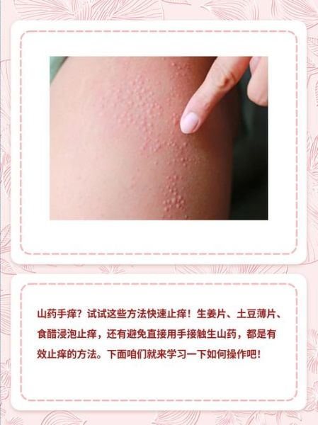 碰到山药皮肤痒怎么办_山药手痒快速止痒方法-第3张图片-山城妙识 碰到山药皮肤痒怎么办_山药手痒快速止痒方法-第3张图片-山城妙识