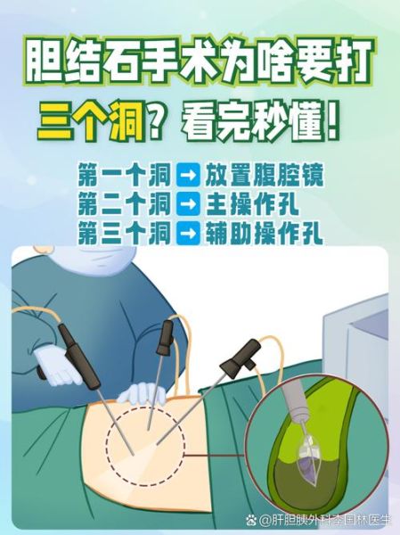 胆结石多大必须做手术_手术指征详解-第3张图片-山城妙识 胆结石多大必须做手术_手术指征详解-第3张图片-山城妙识