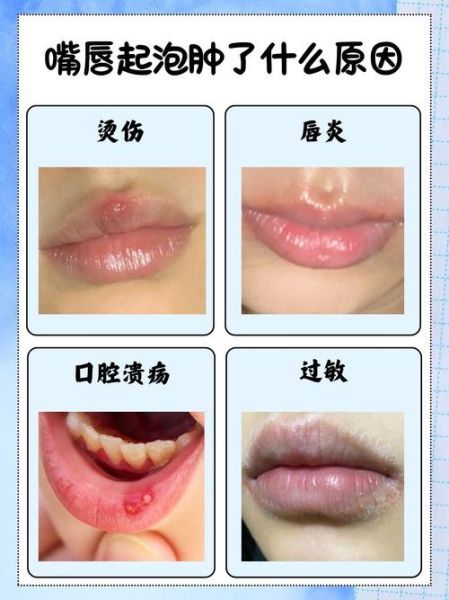 嘴唇起泡怎么办_嘴唇起泡怎么快速消除-第1张图片-山城妙识