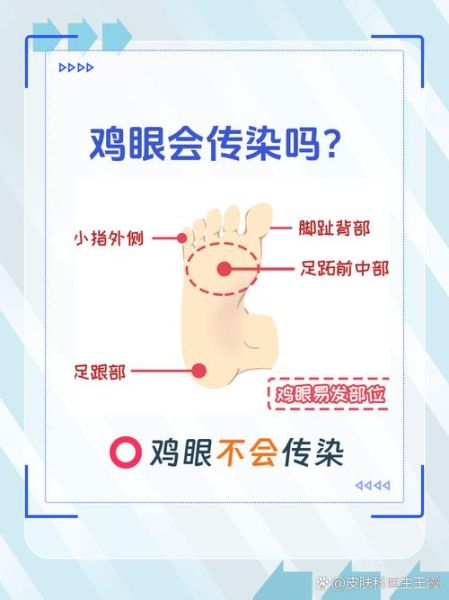 鸡眼是怎么形成的_鸡眼是什么原因引起的-第3张图片-山城妙识