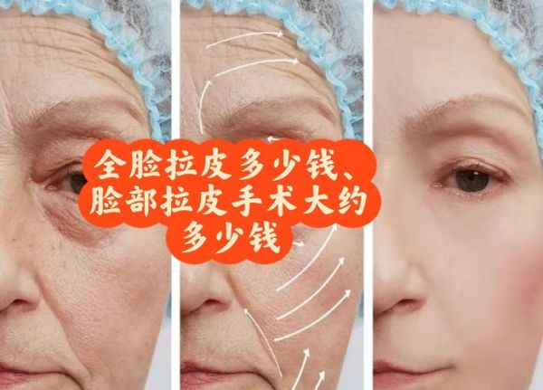 拉皮手术价格一览表_拉皮手术多少钱-第2张图片-山城妙识