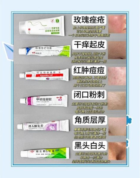 玫瑰痤疮怎么根治_玫瑰痤疮用什么药膏-第1张图片-山城妙识