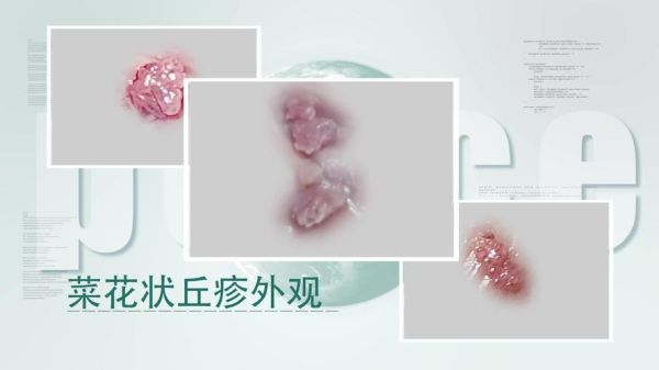 男性菜花病初期症状图片_菜花病长什么样-第2张图片-山城妙识