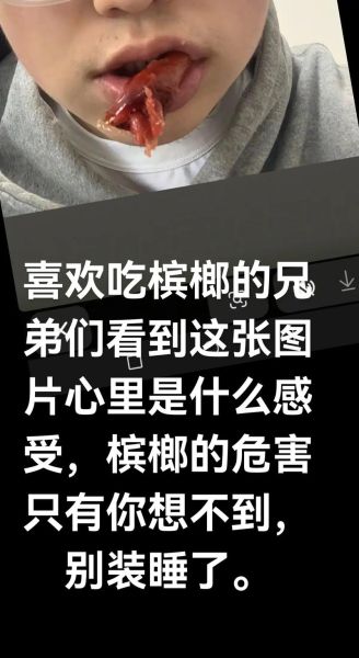 长期吃槟榔的危害有哪些_槟榔致癌是真的吗-第2张图片-山城妙识