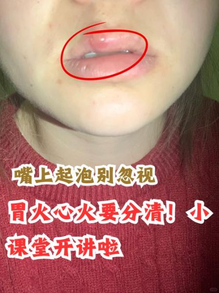 嘴上起泡怎样快速下去_嘴角起泡几天能好-第3张图片-山城妙识 嘴上起泡怎样快速下去_嘴角起泡几天能好-第3张图片-山城妙识
