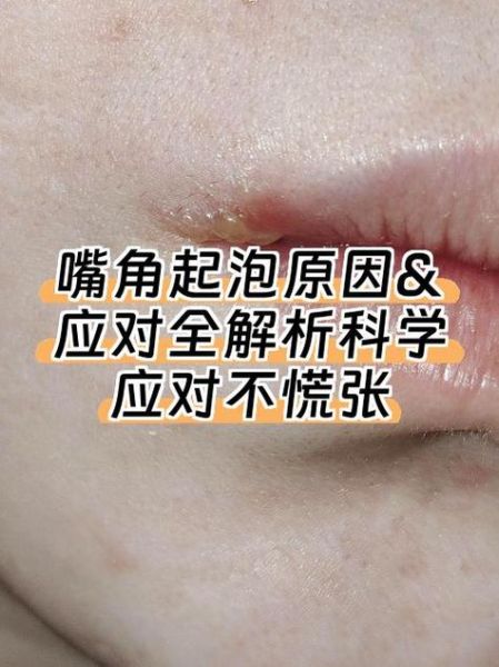 嘴上起泡怎样快速下去_嘴角起泡几天能好-第2张图片-山城妙识 嘴上起泡怎样快速下去_嘴角起泡几天能好-第2张图片-山城妙识