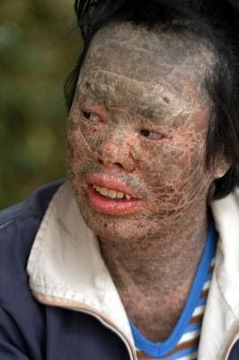 莲蓬乳密集恐惧症图片_为什么会引起不适-第3张图片-山城妙识