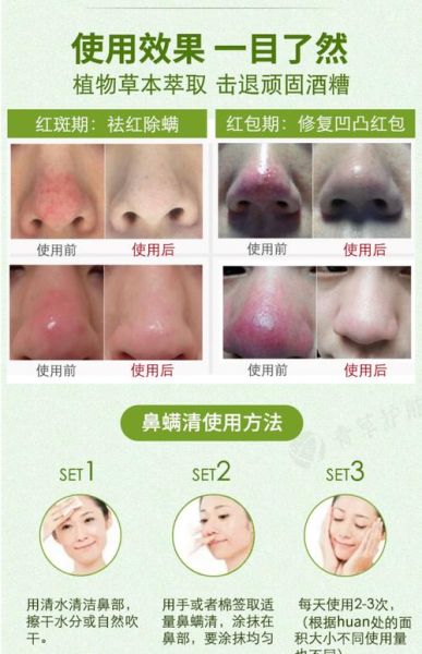 草莓鼻子怎么去掉_还能缩小毛孔吗-第3张图片-山城妙识