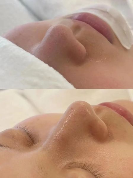 草莓鼻子怎么去掉_还能缩小毛孔吗-第2张图片-山城妙识