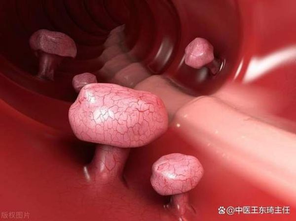 乌梅能治好胆囊息肉吗_乌梅治疗胆囊息肉多久见效-第3张图片-山城妙识