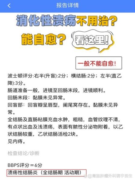 胃溃疡不吃药能自愈吗_胃溃疡多久能好-第1张图片-山城妙识 胃溃疡不吃药能自愈吗_胃溃疡多久能好-第1张图片-山城妙识