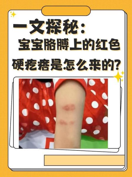 宝宝过敏起红疙瘩怎么办_宝宝过敏红疙瘩怎么快速止痒-第1张图片-山城妙识 宝宝过敏起红疙瘩怎么办_宝宝过敏红疙瘩怎么快速止痒-第1张图片-山城妙识