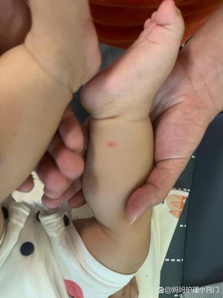 宝宝过敏起红疙瘩怎么办_宝宝过敏红疙瘩怎么快速止痒-第3张图片-山城妙识 宝宝过敏起红疙瘩怎么办_宝宝过敏红疙瘩怎么快速止痒-第3张图片-山城妙识