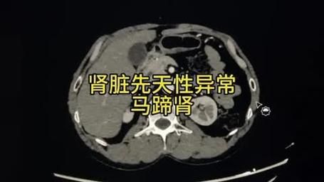 马蹄肾是怎么回事_马蹄肾严重吗-第3张图片-山城妙识 马蹄肾是怎么回事_马蹄肾严重吗-第3张图片-山城妙识