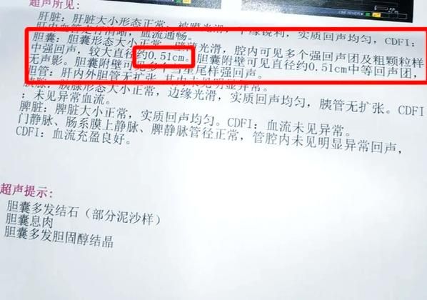 胆结石手术费用多少钱_胆结石手术多久恢复-第2张图片-山城妙识