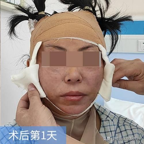 拉皮怎么做出来的_拉皮手术全过程揭秘-第2张图片-山城妙识