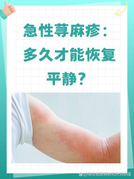 过敏多久会自行消退_过敏症状几天能好-第3张图片-山城妙识