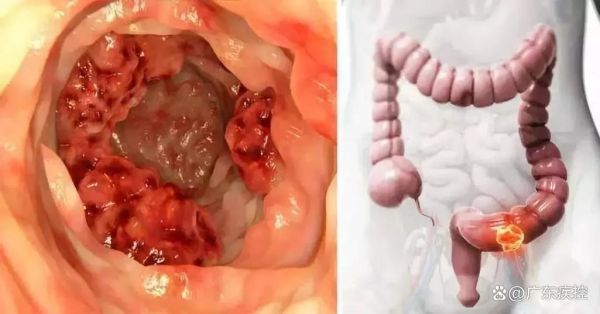 肠癌大便图片_肠癌早期大便特征-第3张图片-山城妙识