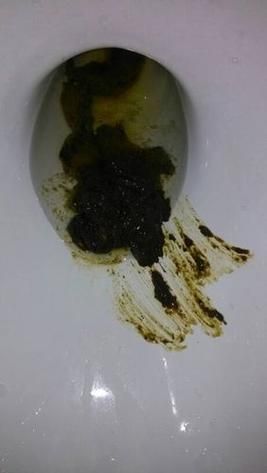 肠癌大便图片_肠癌早期大便特征-第1张图片-山城妙识