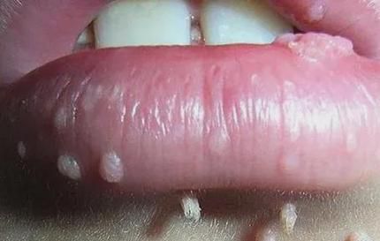 女性菜花病初期症状图片_女性菜花病怎么治疗-第2张图片-山城妙识