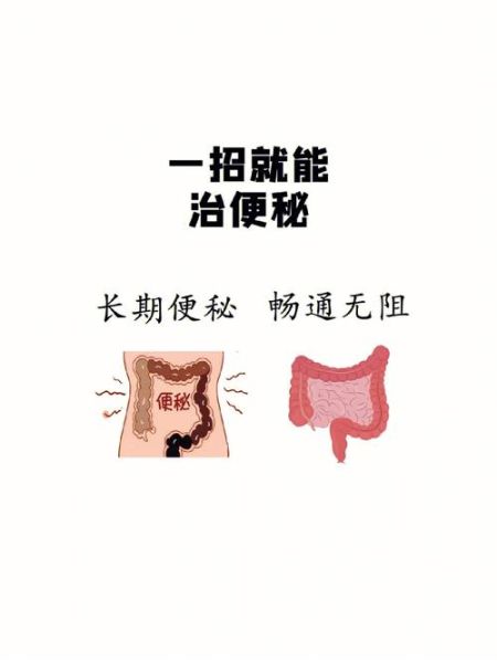 便秘怎么办_快速解决8种方法-第2张图片-山城妙识