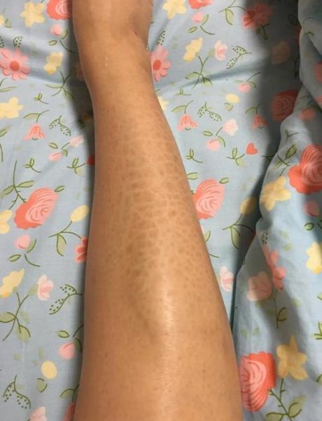 鱼鳞皮肤病怎么根治_鱼鳞皮肤病会遗传吗-第1张图片-山城妙识 鱼鳞皮肤病怎么根治_鱼鳞皮肤病会遗传吗-第1张图片-山城妙识