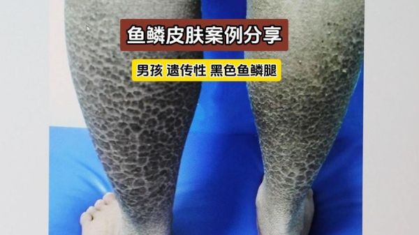 鱼鳞皮肤病怎么根治_鱼鳞皮肤病会遗传吗-第2张图片-山城妙识 鱼鳞皮肤病怎么根治_鱼鳞皮肤病会遗传吗-第2张图片-山城妙识