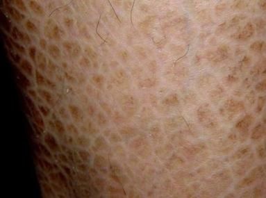 鱼鳞皮肤病怎么根治_鱼鳞皮肤病会遗传吗-第3张图片-山城妙识 鱼鳞皮肤病怎么根治_鱼鳞皮肤病会遗传吗-第3张图片-山城妙识