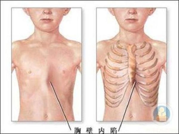 佝偻病早期症状图片_佝偻病能治好吗-第1张图片-山城妙识