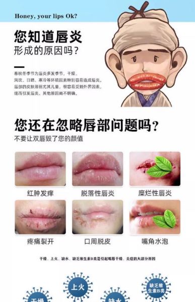 嘴唇上火起泡怎么快速消除_嘴角起泡几天能好-第3张图片-山城妙识 嘴唇上火起泡怎么快速消除_嘴角起泡几天能好-第3张图片-山城妙识