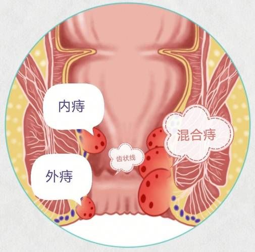 女性痔疮图片_痔疮长什么样-第1张图片-山城妙识