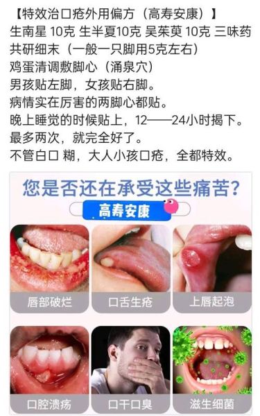 治口疮民间最好偏方_口腔溃疡怎么快速好-第1张图片-山城妙识
