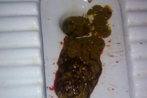 早期肠癌大便图片_肠癌大便颜色形状变化-第1张图片-山城妙识 早期肠癌大便图片_肠癌大便颜色形状变化-第1张图片-山城妙识