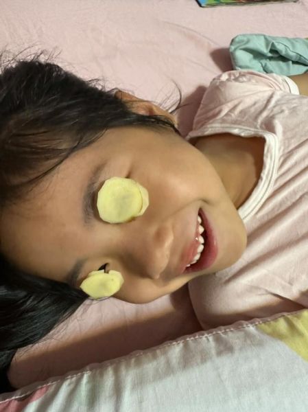 土豆片消肿能敷一夜吗_土豆片敷脸过夜安全吗-第3张图片-山城妙识