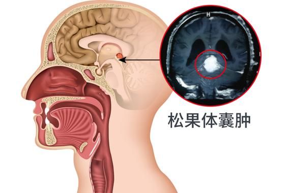 松果体囊肿严重吗_需要手术吗-第1张图片-山城妙识