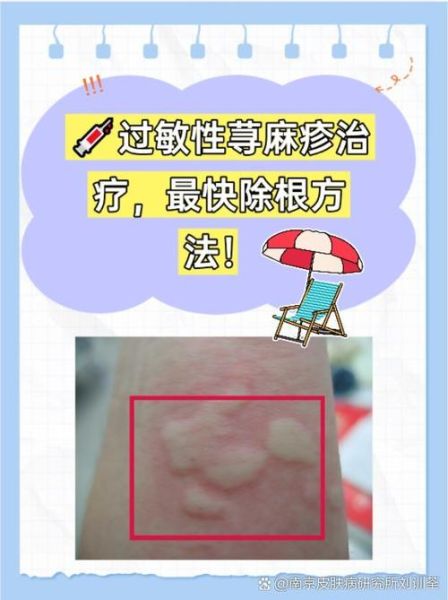 大蒜治荨麻疹真的有用吗_怎么用大蒜快速止痒-第1张图片-山城妙识 大蒜治荨麻疹真的有用吗_怎么用大蒜快速止痒-第1张图片-山城妙识