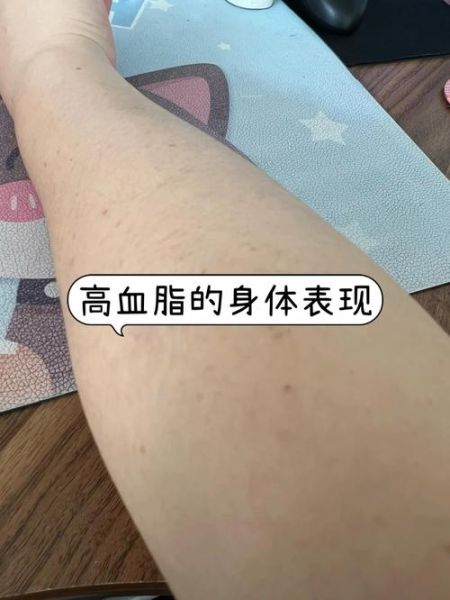 女性血脂高的早期症状_血脂高早期有哪些表现-第2张图片-山城妙识