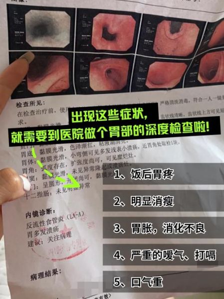 得了胃溃疡能活多少年_胃溃疡会不会影响寿命-第1张图片-山城妙识