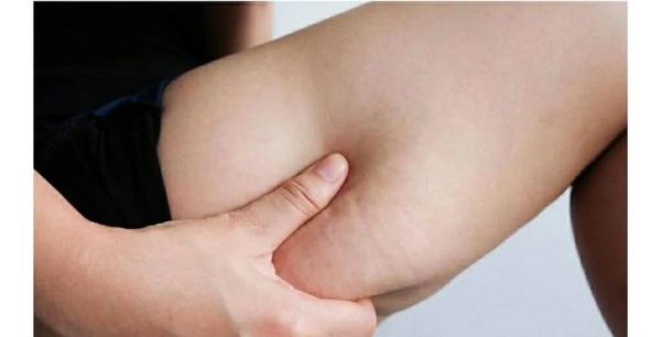 橘皮组织怎么消除_橘皮组织是怎么形成的-第1张图片-山城妙识