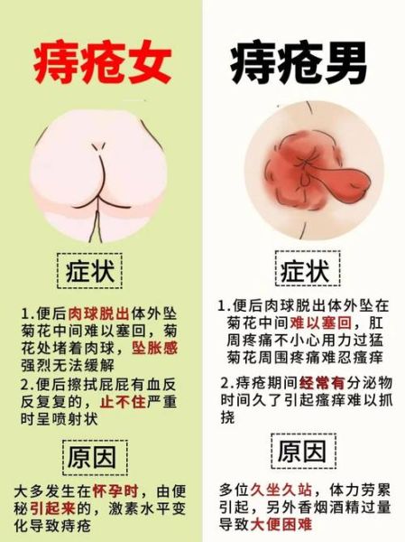 痔疮一期二期三期图片_如何区分严重程度-第2张图片-山城妙识
