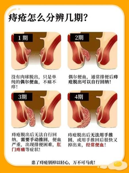 痔疮一期二期三期图片_如何区分严重程度-第1张图片-山城妙识