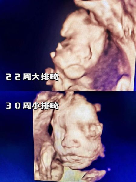 大排畸和小排畸检查区别_什么时候做最合适-第2张图片-山城妙识