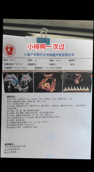 大排畸和小排畸检查区别_什么时候做最合适-第3张图片-山城妙识