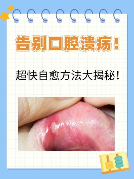口腔溃疡怎么快速好_口腔溃疡偏方大全-第3张图片-山城妙识