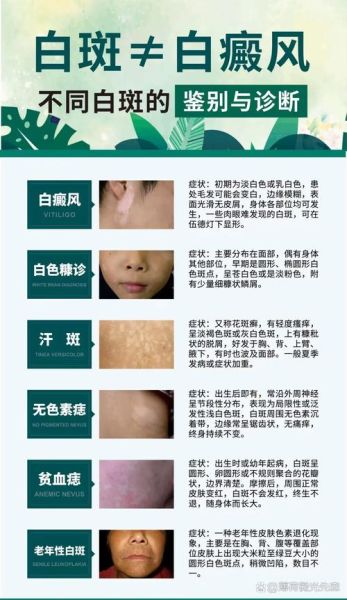 色素减退白斑是怎么造成的_白斑初期症状有哪些-第2张图片-山城妙识